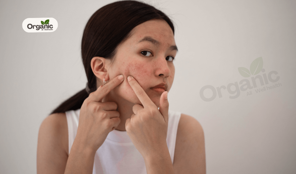 Acne | Types, causes and prevention of this skin infection