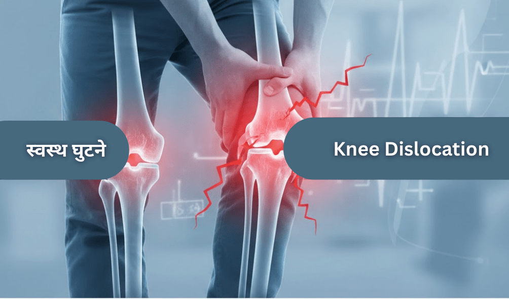 Knee Dislocation (घुटने का उतरना): लक्षण, कारण और उपचार ...
